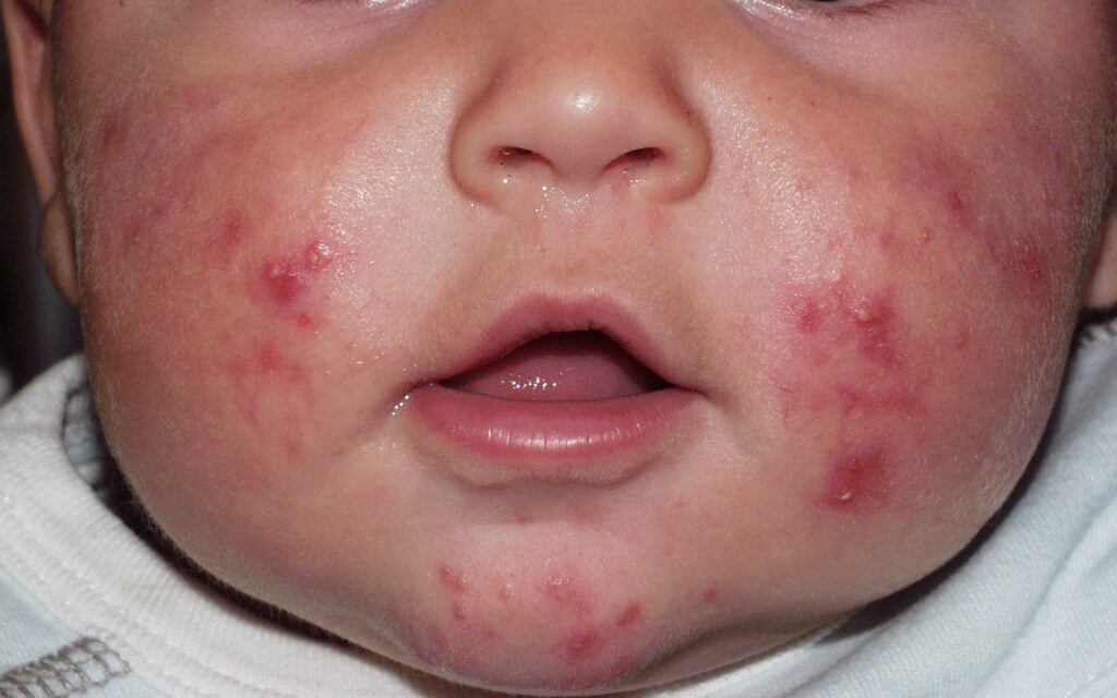 Acné en los niños - Clinica DermoMedic